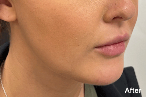 Discover the Allure of Quantum RF Body Contouring by InMode