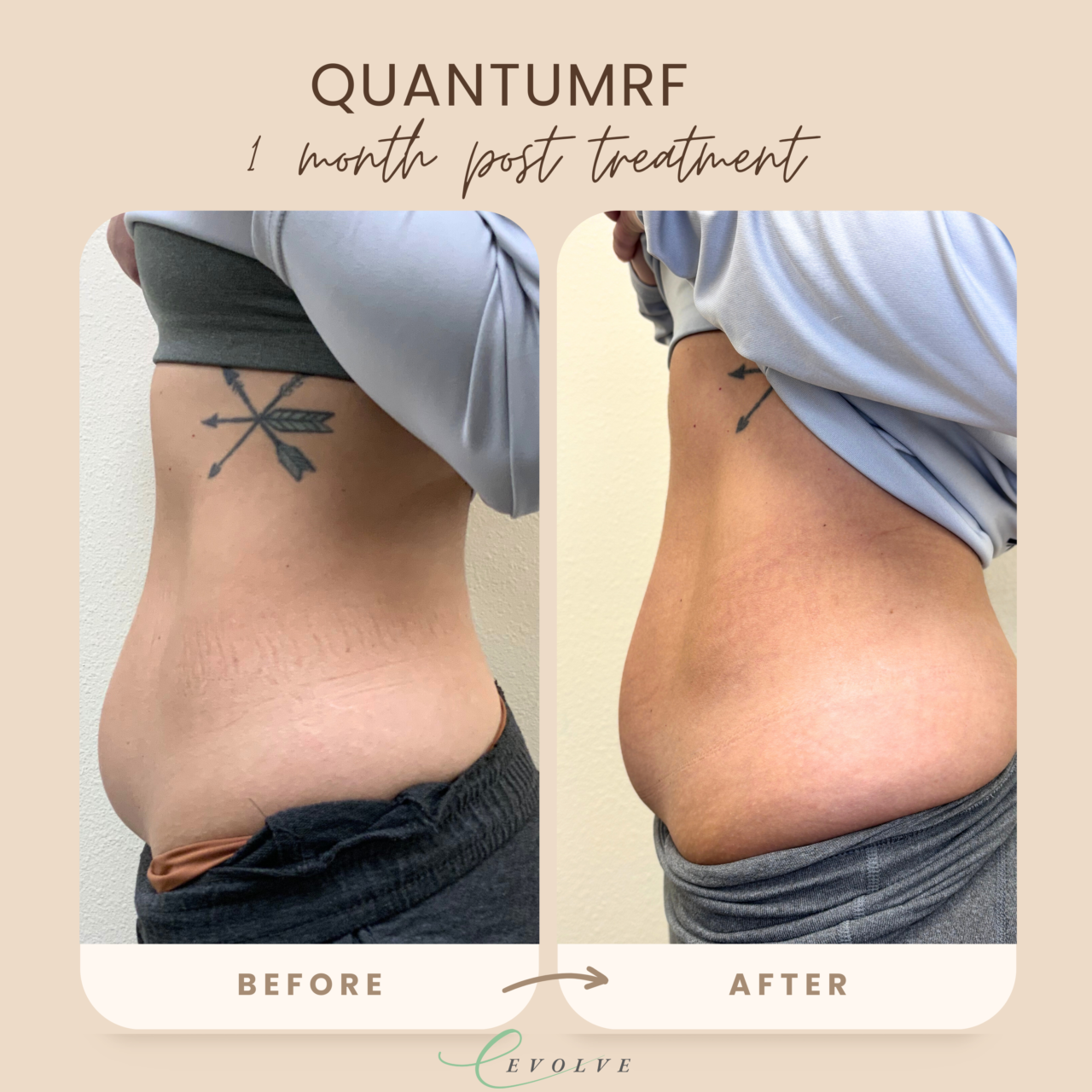 Discover the Allure of Quantum RF Body Contouring by InMode