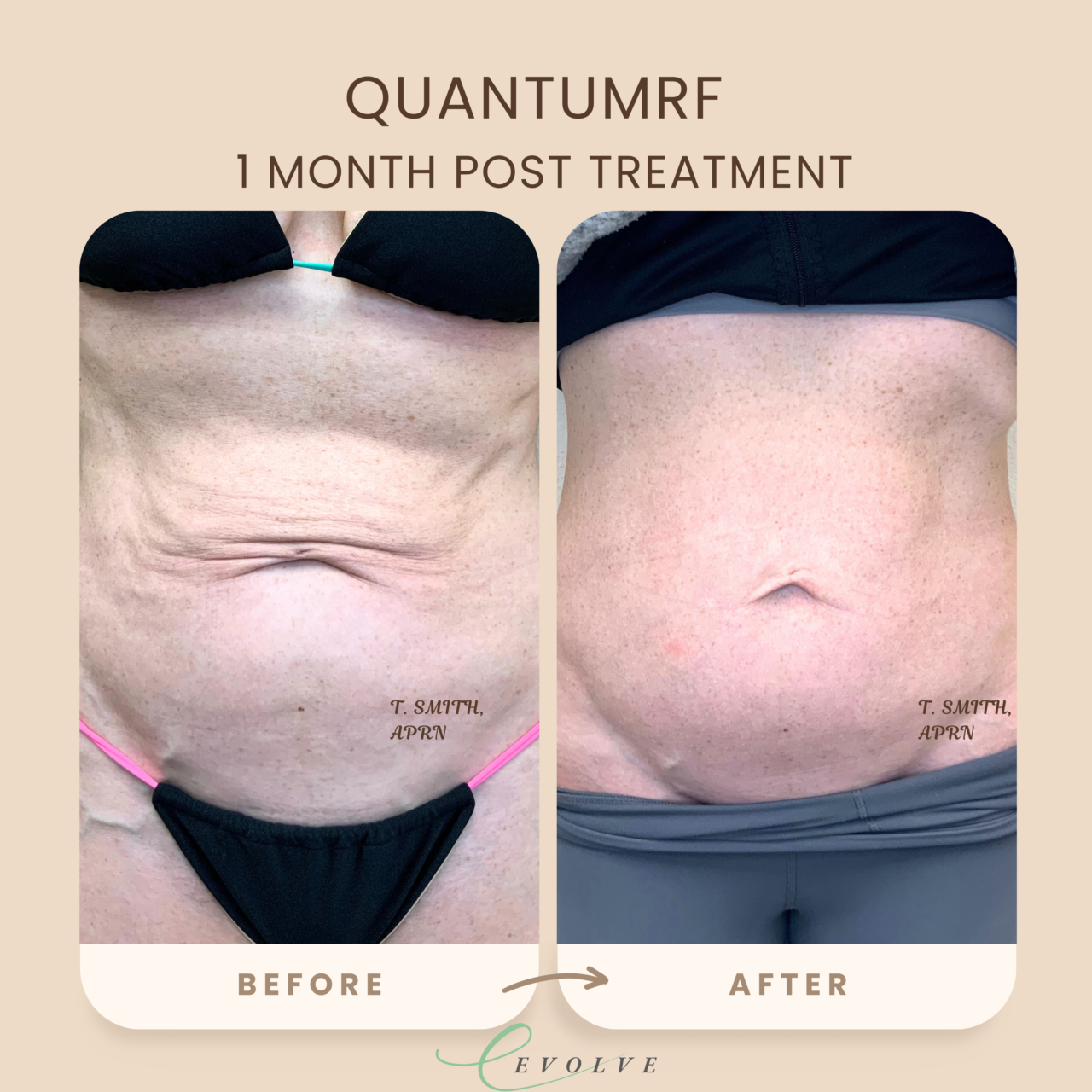 Discover the Allure of Quantum RF Body Contouring by InMode